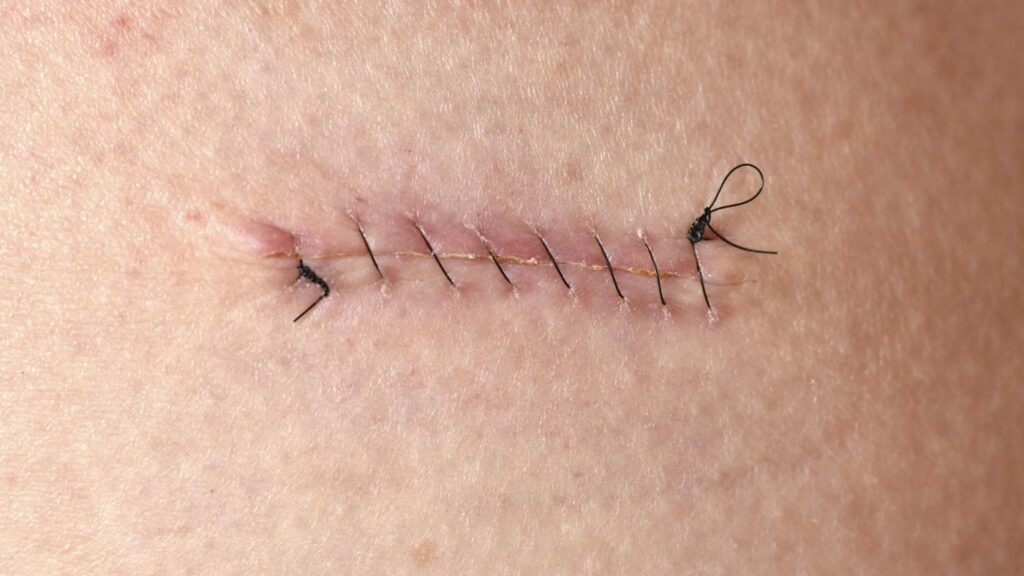 Wound Closure + Suturing - Face to Face Course - Medline Consultancy